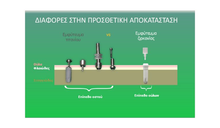 ΕΞΑΤΟΜΙΚΕΥΜΕΝΑ ΕΜΦΥΤΕΥΜΑΤΑ | Οδοντιατρείο Καραπατάκη Σοφία